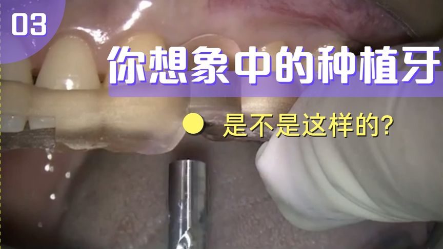 种植牙的全过程,你还没有见过?