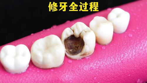 根管治疗补牙全过程牙痛不是病痛起来要人命