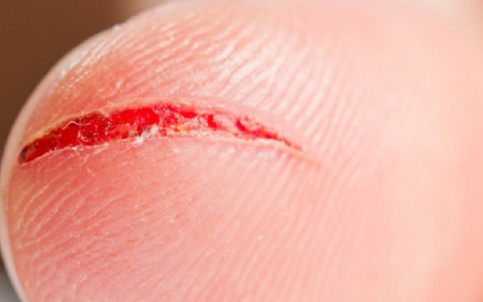 人体受伤后伤口是怎样愈合的?动画模拟全过程,场面一目了然