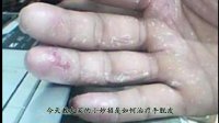 手脱皮了不用怕, 去买瓶维生素C注射液, 自己轻松搞定手脱皮