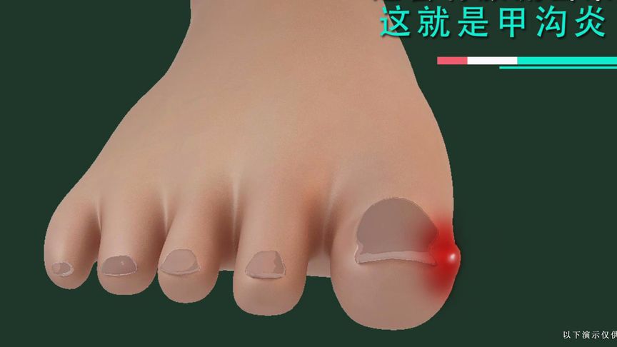 甲沟炎是怎么形成的?3D演示过程,剪指甲也要小心呀