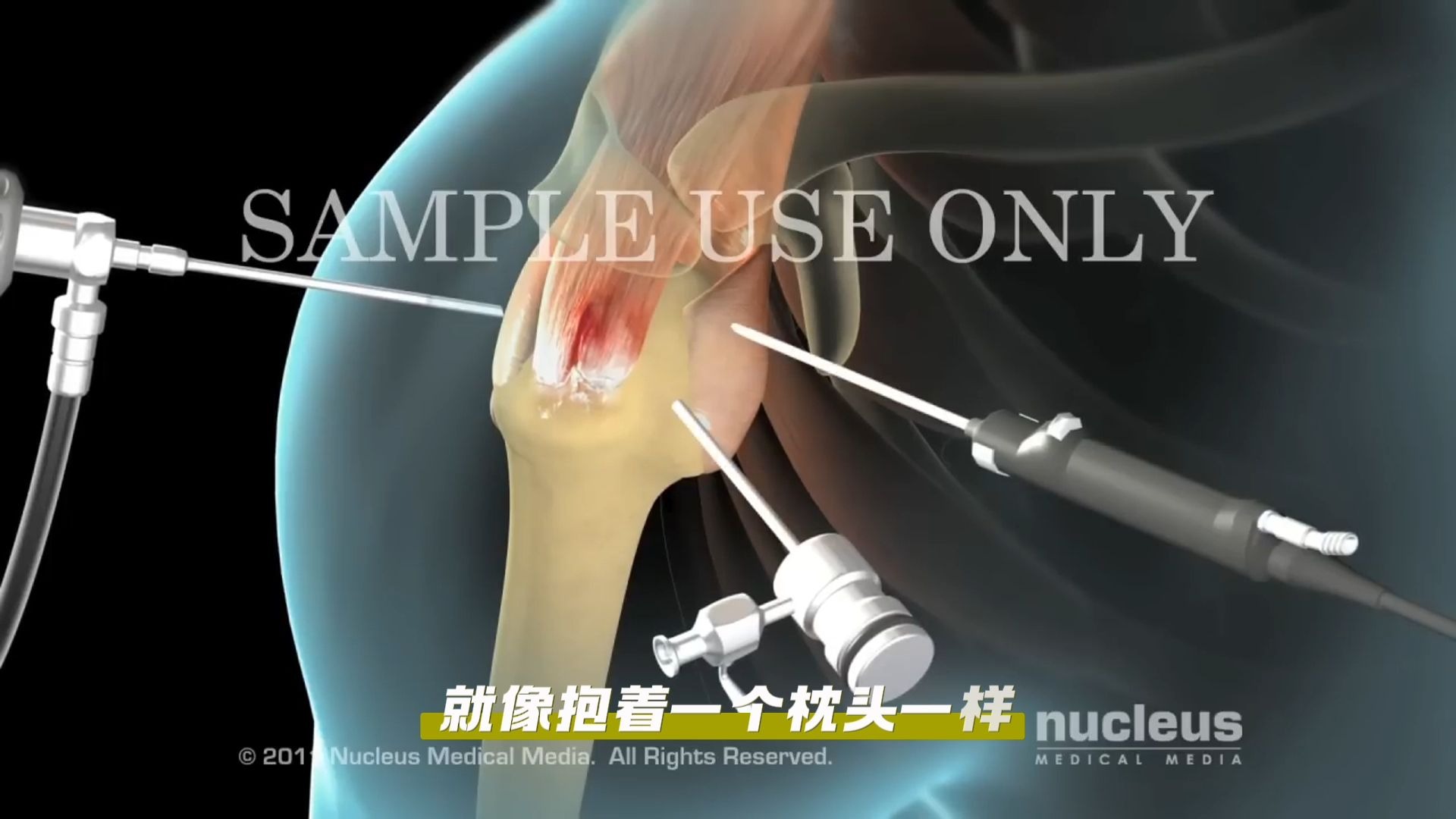 肩袖损伤的手术治疗--关节镜下肩袖修补术的规范操作流程