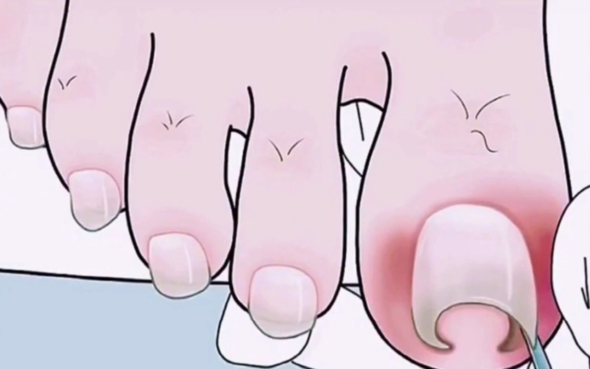 【沉浸式修脚】 内生脚趾甲修脚 _基础修脚动画