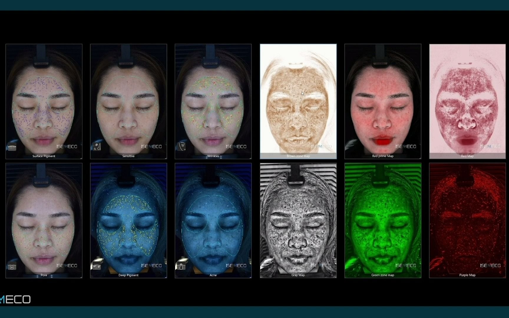 美测MC | ISEMECO 以色美科 肌肤影像分析仪 深斑敏感案例