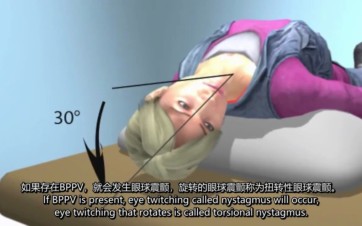 Dix-Hallpike试验_诊断良性阵发性位置性眩晕(BPPV)