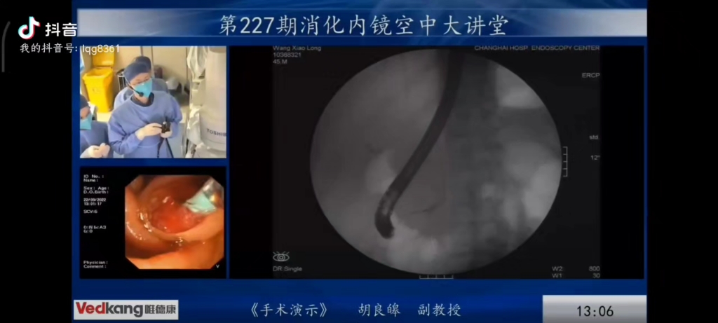 慢性胰腺炎,慢性胰腺炎胰管结石,胡良皞教授ercp内镜取石投放支架