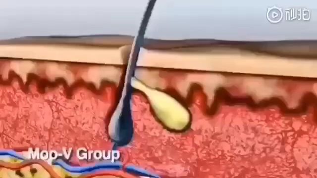 3D演示痘坑痘印的形成ߘ�皮脂腺分泌旺盛毛孔被堵塞是长痘痘的