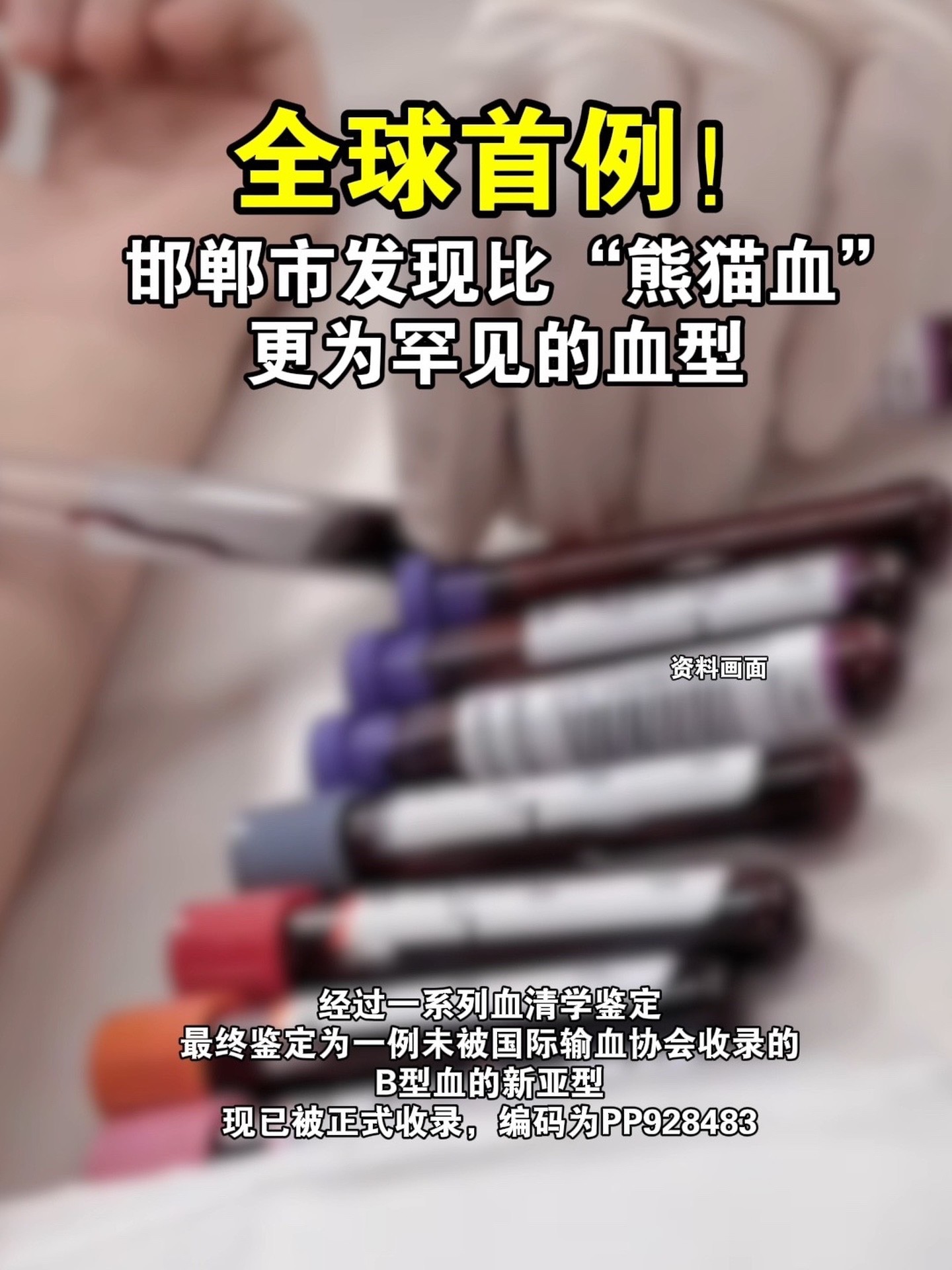 全球首例!河北邯郸市发现“熊猫血”更为罕见的血型