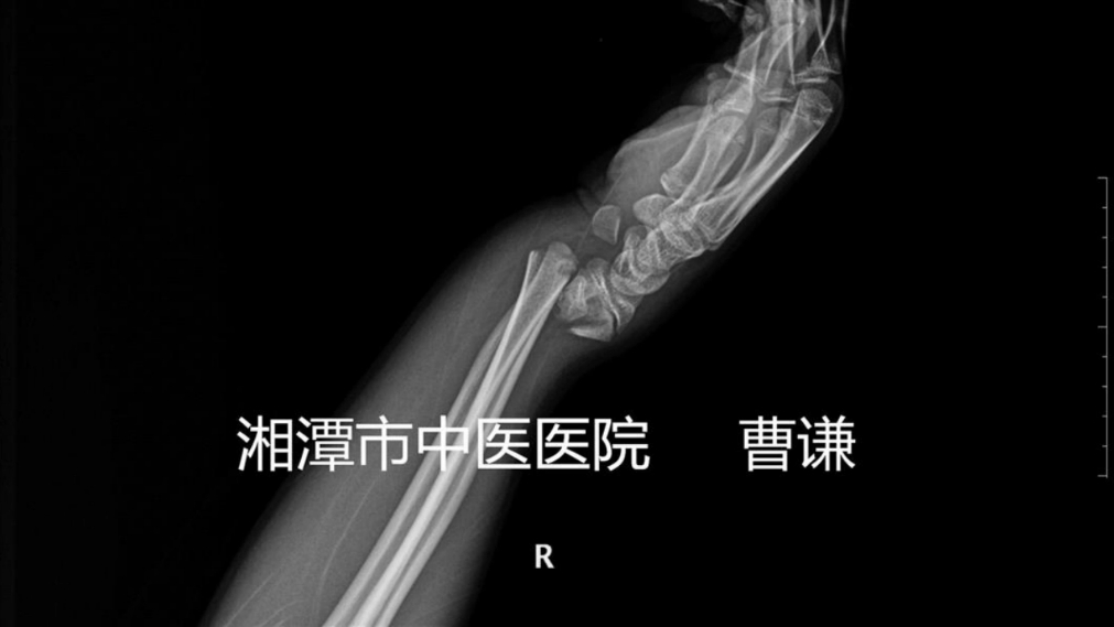 儿童尺桡骨远端双骨折予以手法复位,小夹板外固定治疗,恢复正常。#...