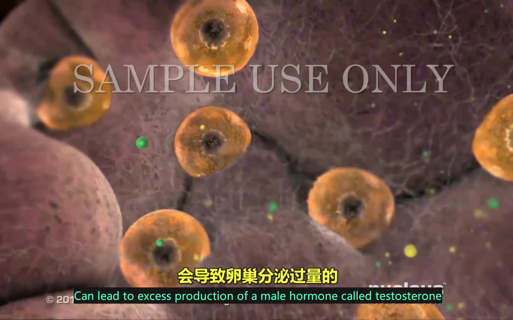 【3D医学动画】多囊卵巢综合征(中英双字幕+原版英文)