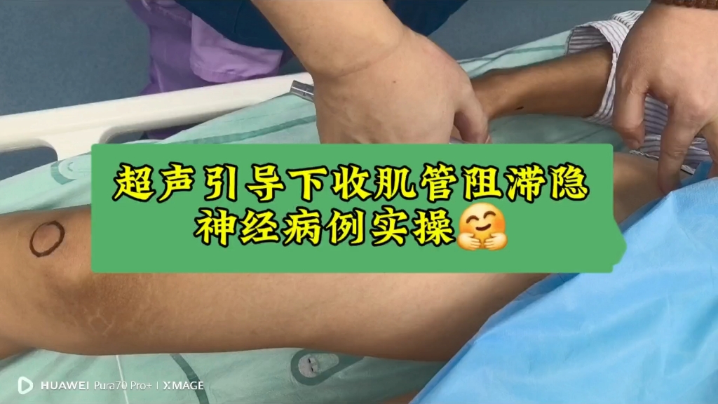 超声引导下收肌管隐神经阻滞病例实操ߤ