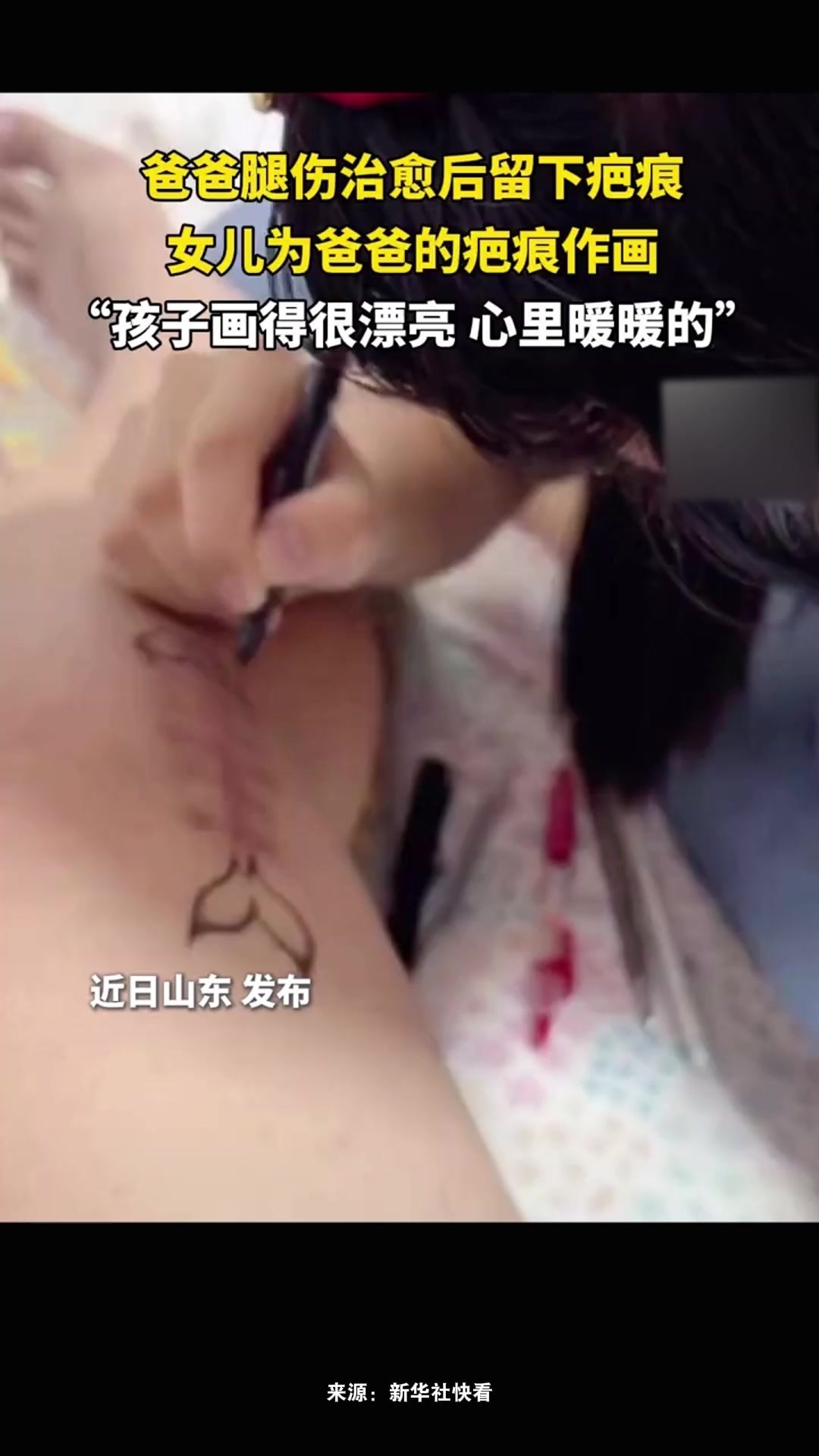 爸爸腿伤治愈后留下疤痕,女儿为爸爸的疤痕作画,"孩子画得很漂亮,心里...