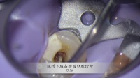 显微镜下一次性根管治疗