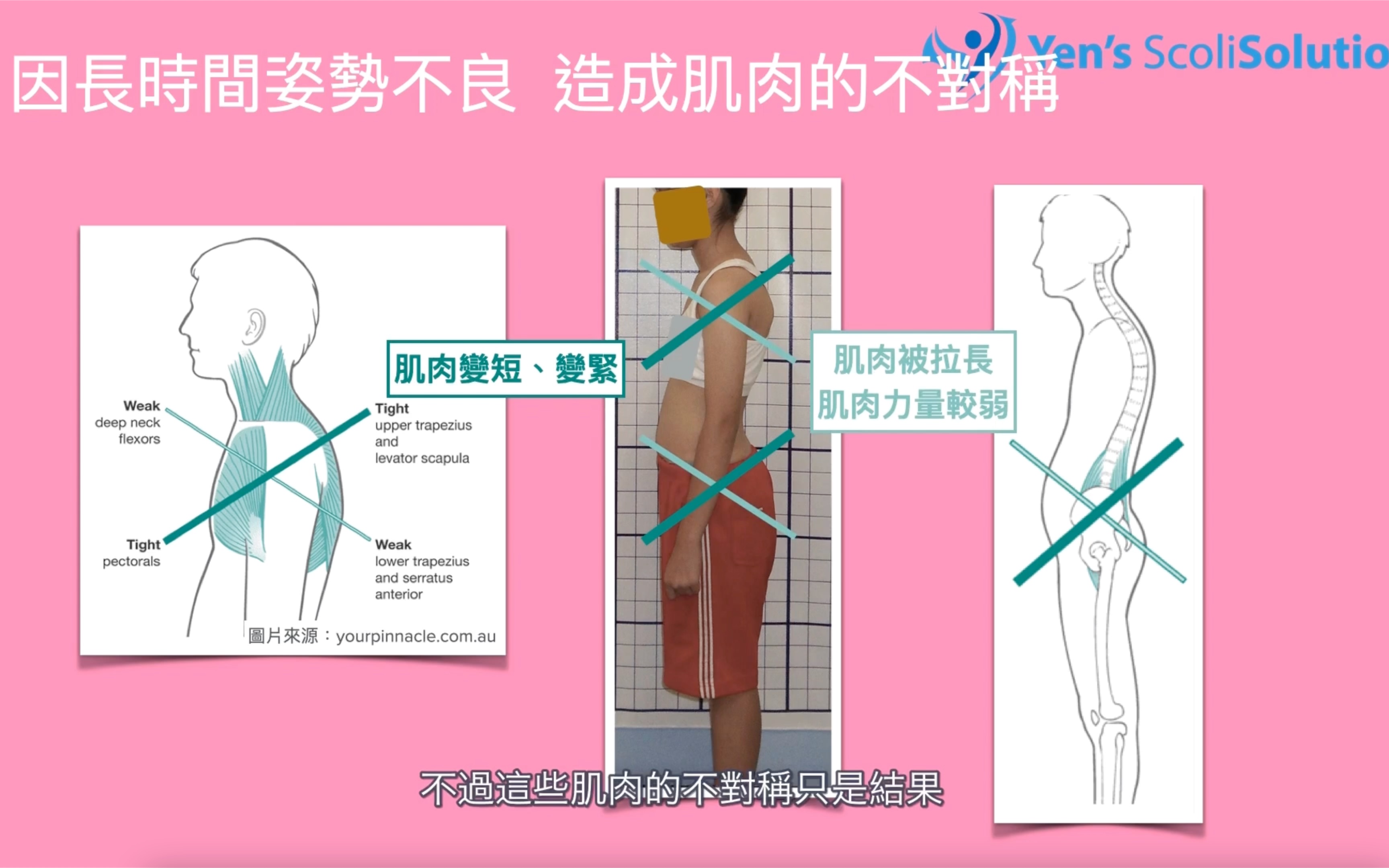 阎晓华说侧弯第十九章:通过大脑学习训练法矫正不良姿势