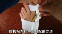 脚拇指外翻矫正器配戴方法
