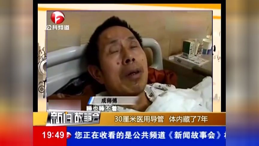 30厘米医用导管 体内藏了7年