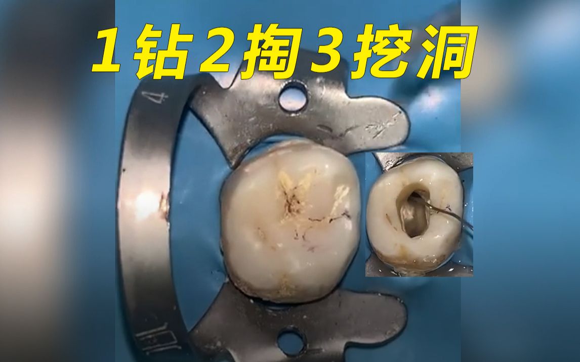 根管治疗前,繁琐的窝洞预备工作