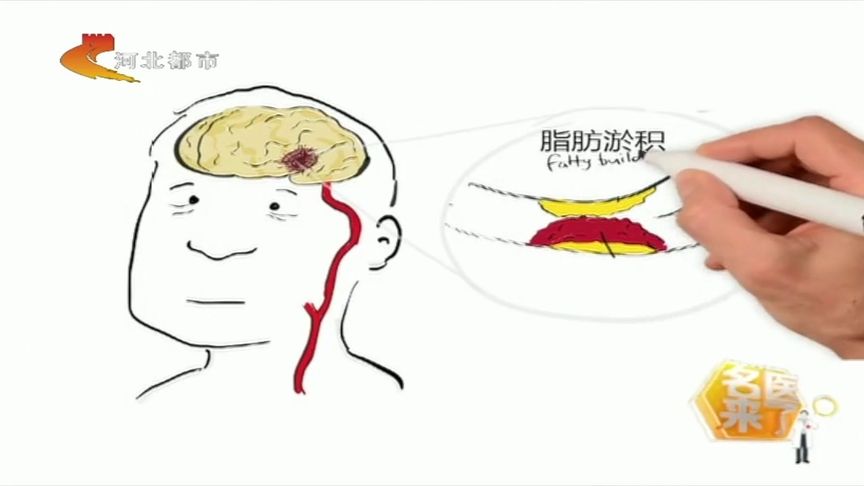 血栓都是在身体中的什么部位形成的?来听听这个小短片咋科普的