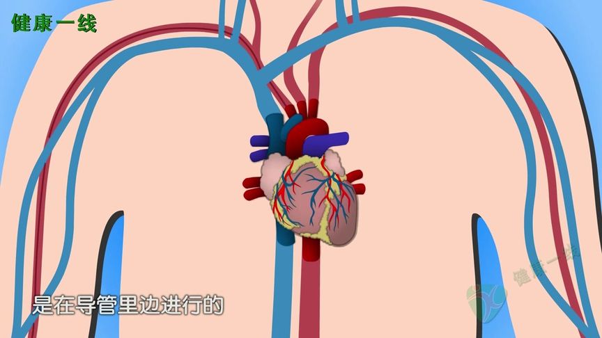 1分钟让你看懂心脏支架的手术过程