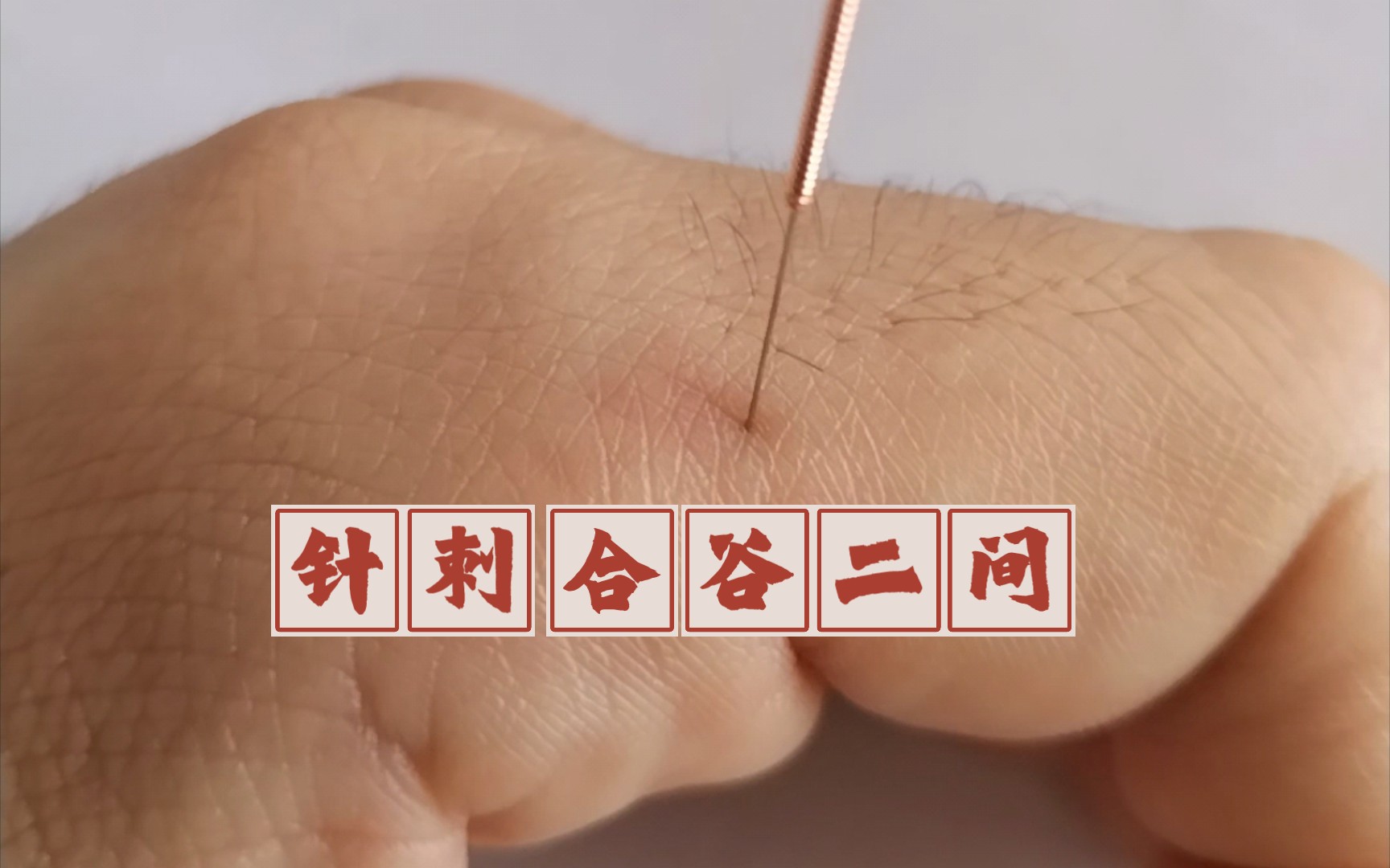 针刺二间穴合谷穴