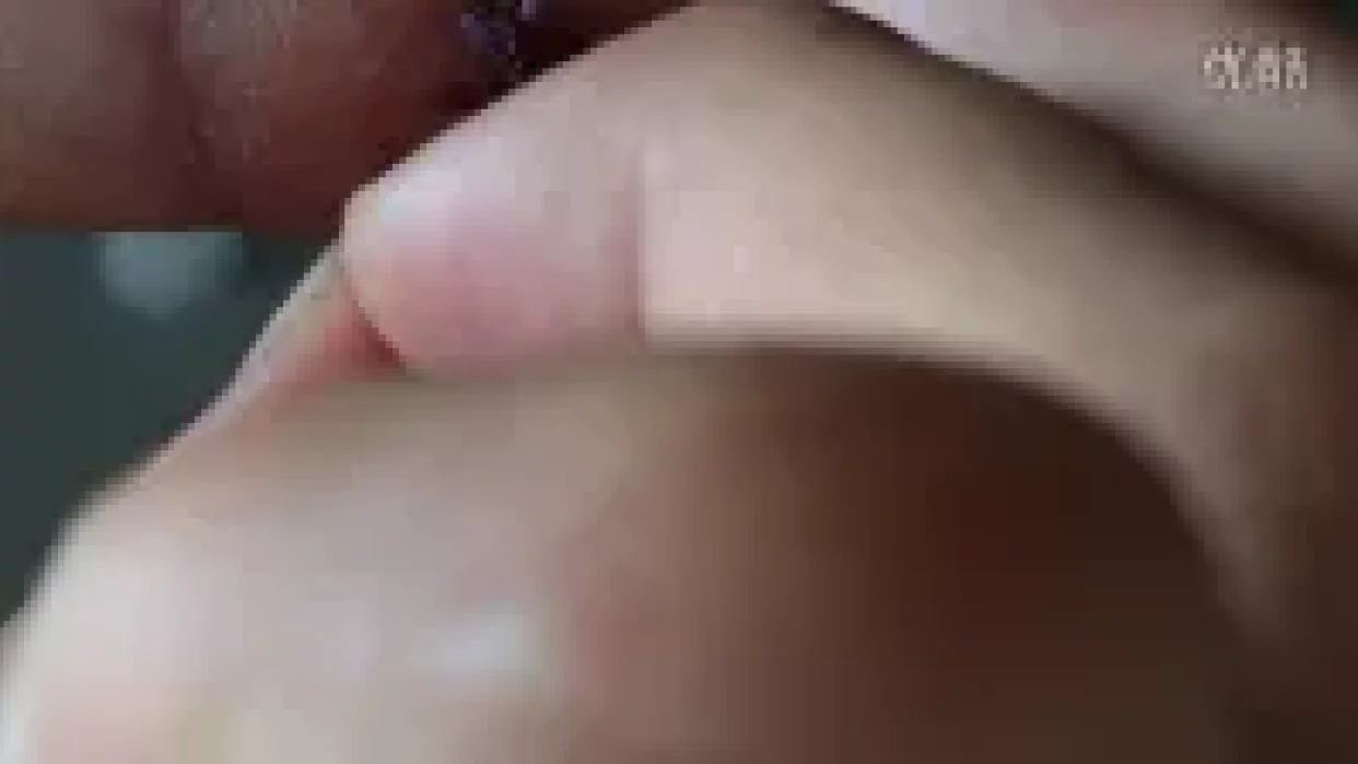 自己动手 伤口拆线