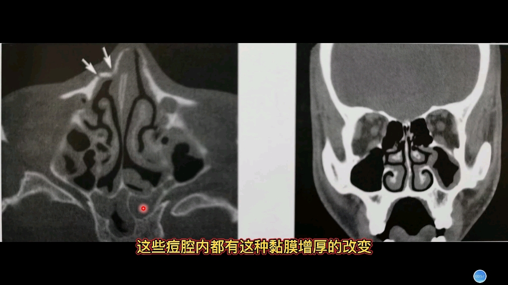 影像诊断知识:副鼻窦常见CT病例分享,放射科医生讲解