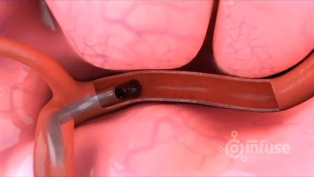 3D视频演示:血栓是怎么清除的,一起来了解一下吧