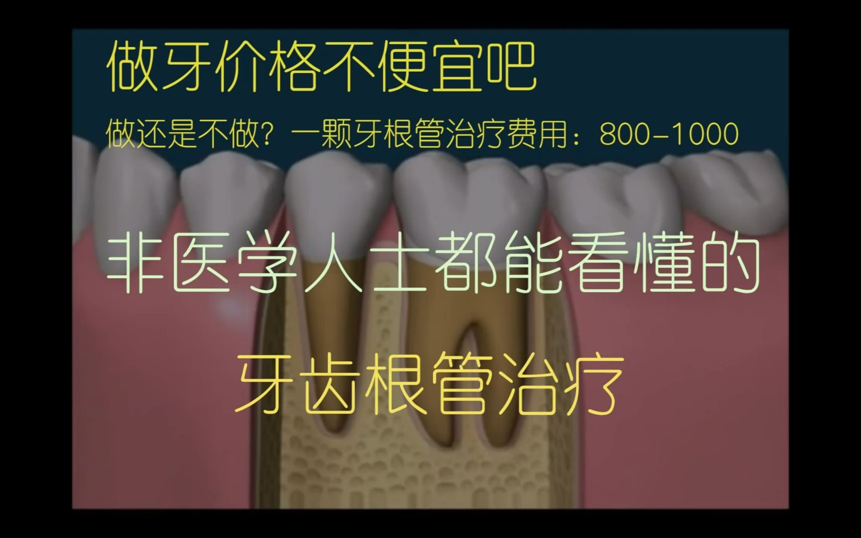 带你了解牙齿根管治疗