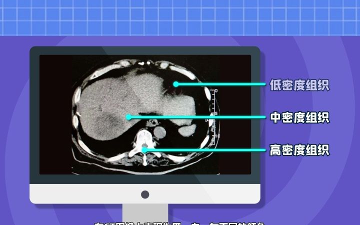 CT成像检查原理是什么