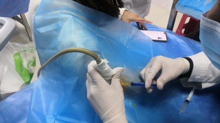 顽固性网球肘,伸肌总腱大撕裂,超声引导下PRP(富血小板血浆