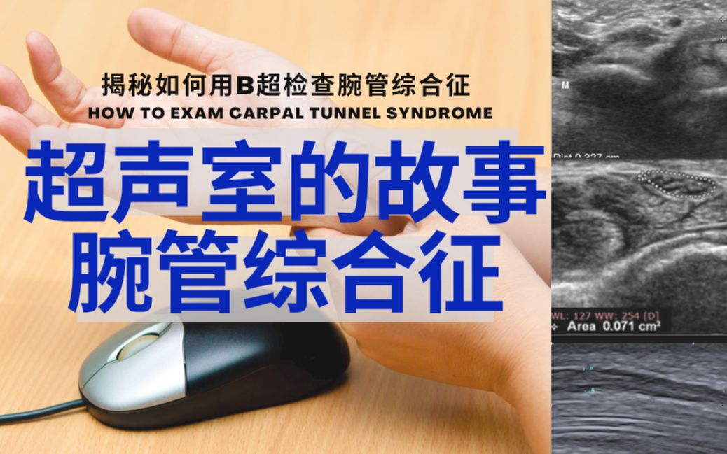 腕管综合征超声:腕管综合征是什么/常见的症状/易患人群/超声如何检查...