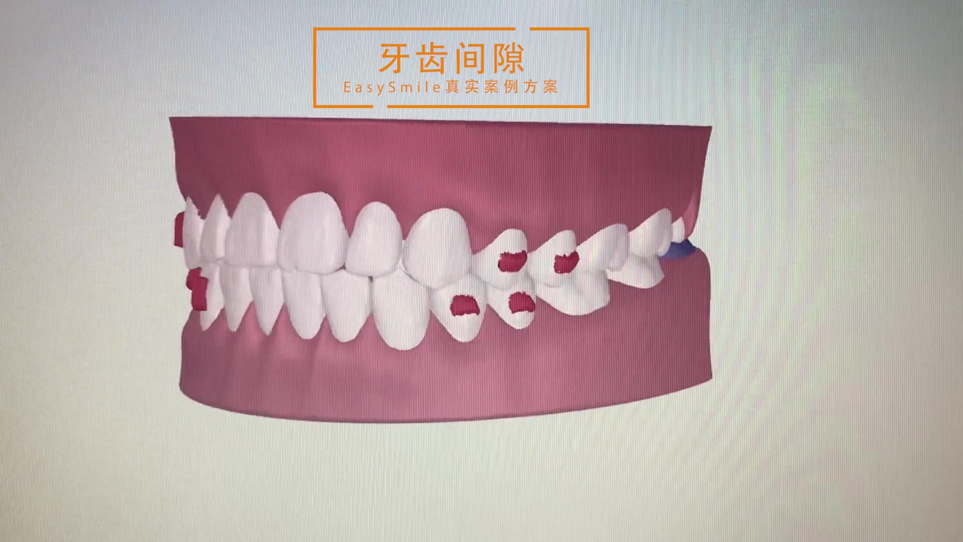 【牙齿隐形矫正】注意!前方视频引起极度舒适!