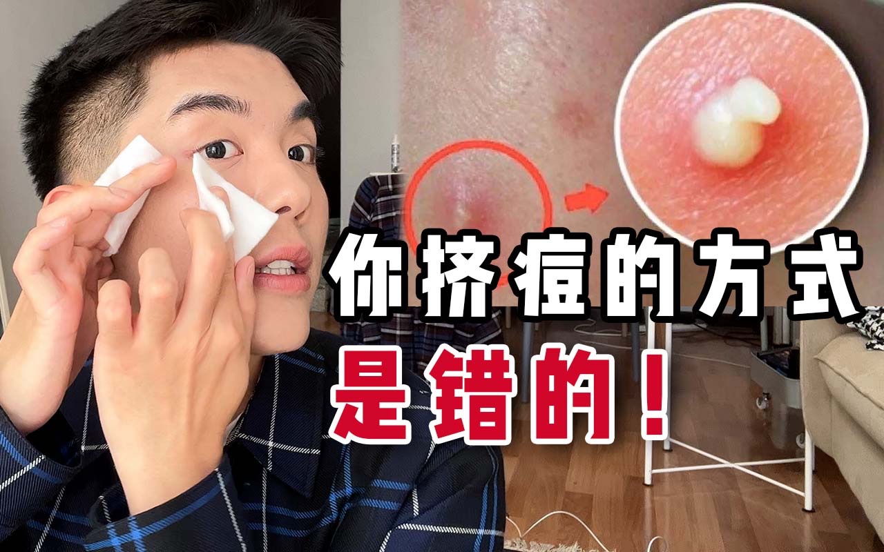 15年抗痘成功经验:白头闭口粉刺,囊肿痘痘到底该怎么挤?