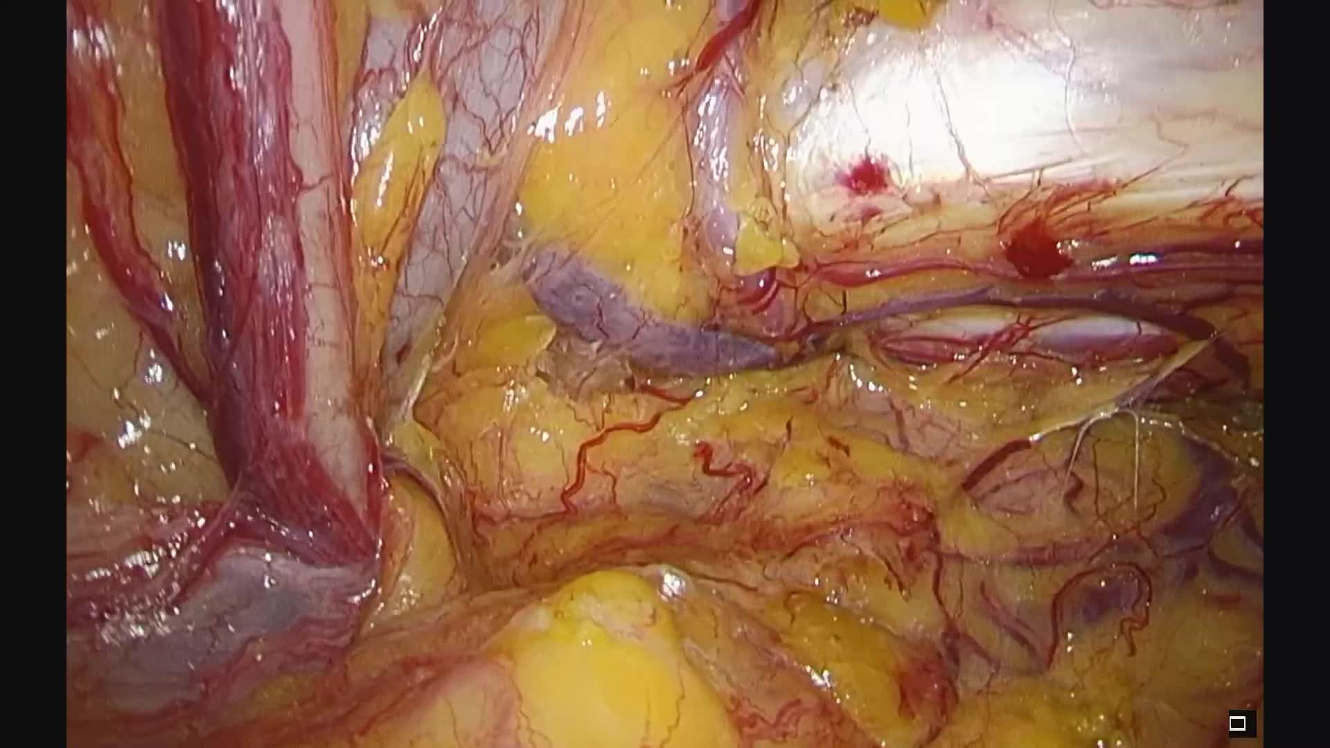 男性股疝,虽然手术区有很多血管,只要手术解剖到位,一般是不会出血的...