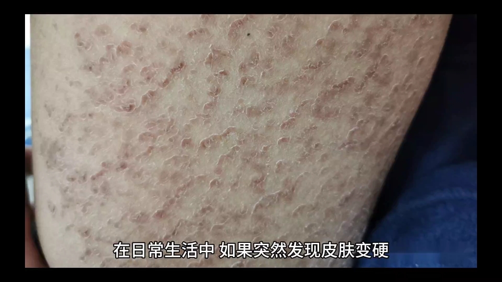 突然皮肤变硬:警惕系统性硬化症这一免疫系统疾病