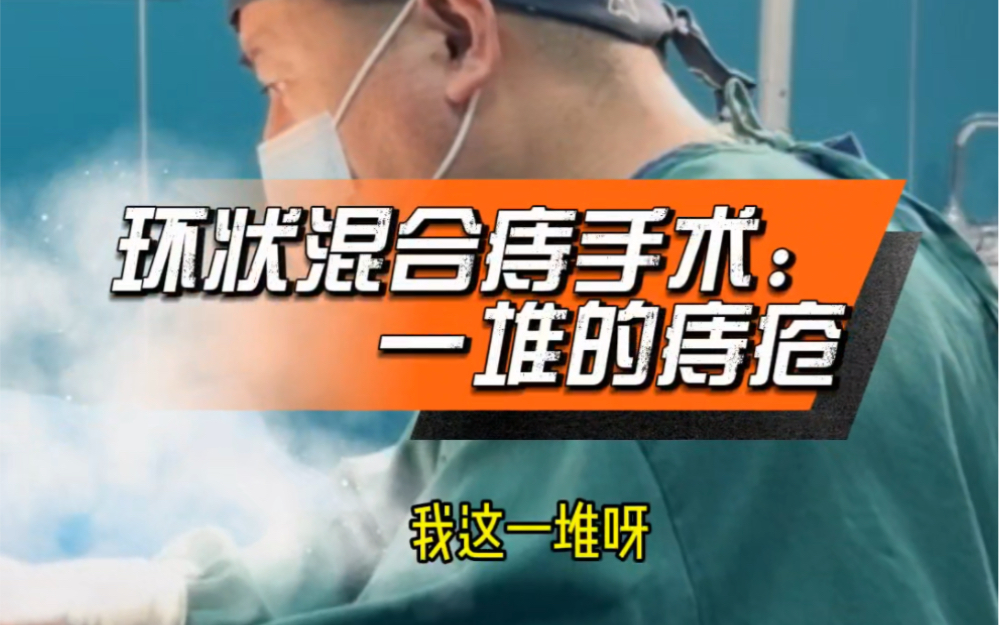 环状混合痔手术: 一堆的痔疮