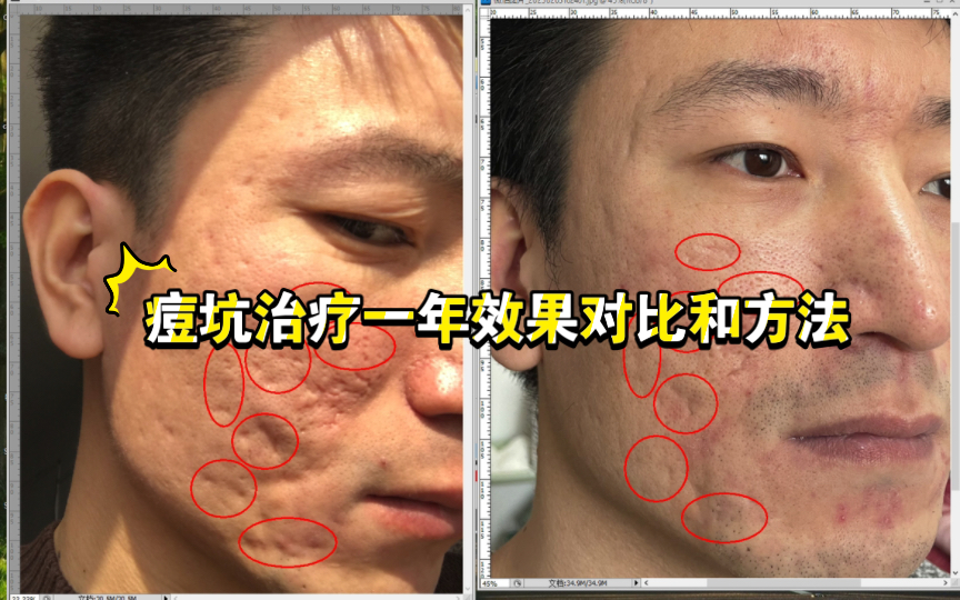 痘坑治疗一年效果对比和治疗的方法