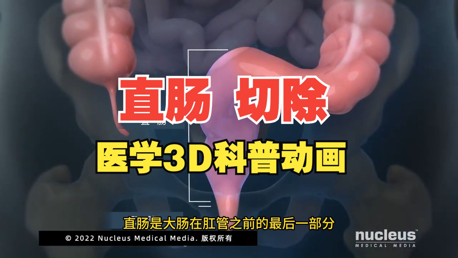 保护好你的直肠!直肠切除术3D动画还原 (nucleus医学科普视频系列)中文