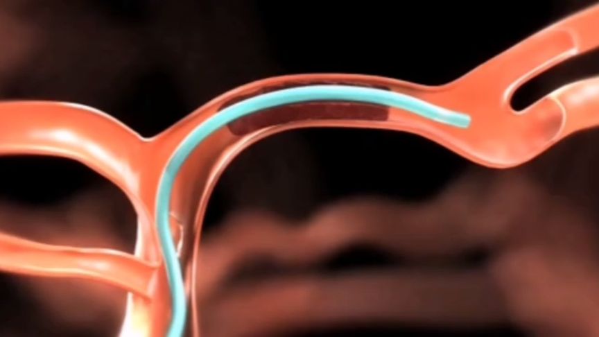 脑血栓的机械取栓方法动画演示