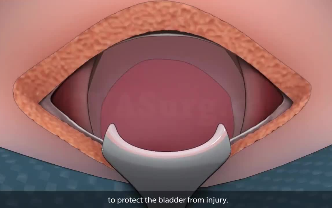 【3D动画】剖腹产动画演示