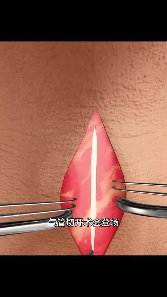 危急时刻的"生命通道":气管切开术如何救人?