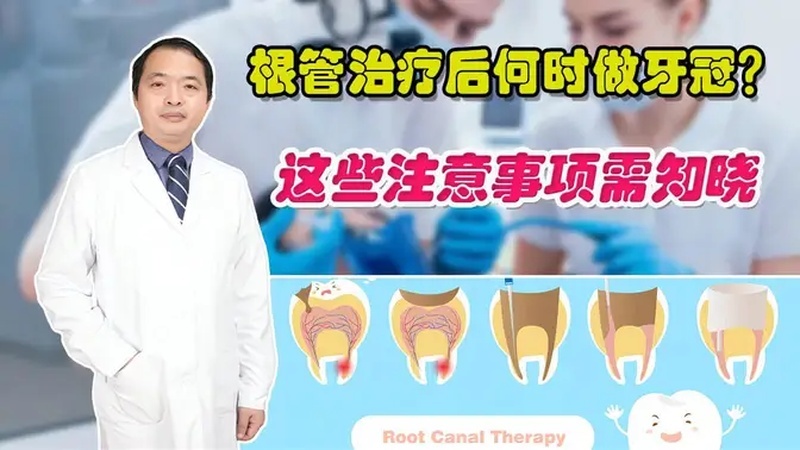 根管治疗后何时做牙冠?这些注意事项需知晓