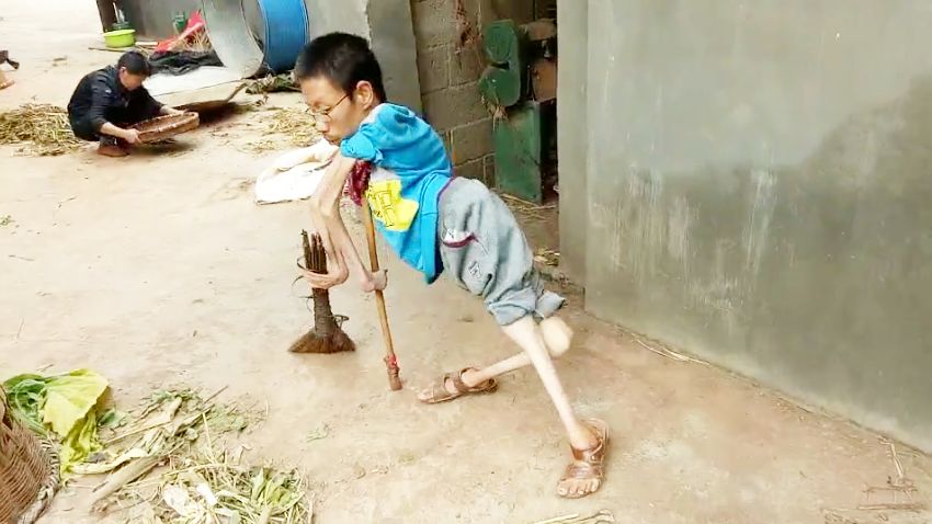 自幼重度残疾,这个农村小伙让人心酸