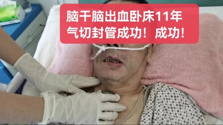 脑干脑出血卧床11年气切封管成功