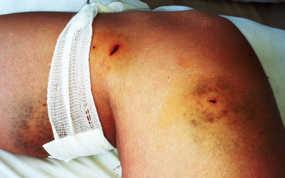 女子被狗咬竟然无药可救,打了狂犬疫苗还是难逃一死?