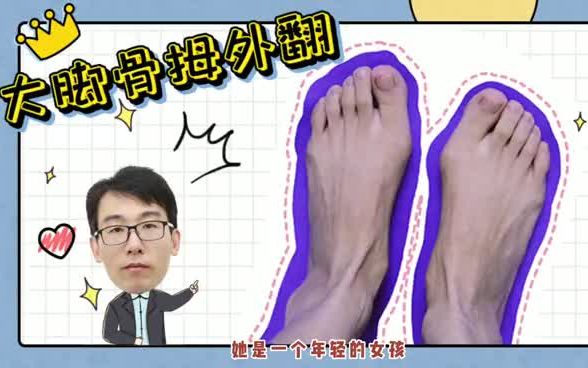 苏敬达大脚骨案例|拇外翻大脚骨怎样治疗?