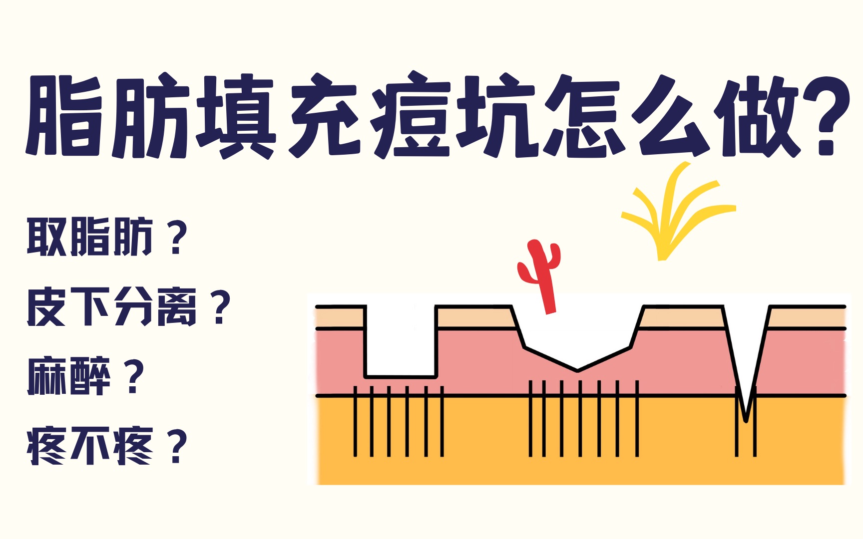 脂肪填充痘坑怎么做?皮下分离 | 取脂肪 | 麻醉