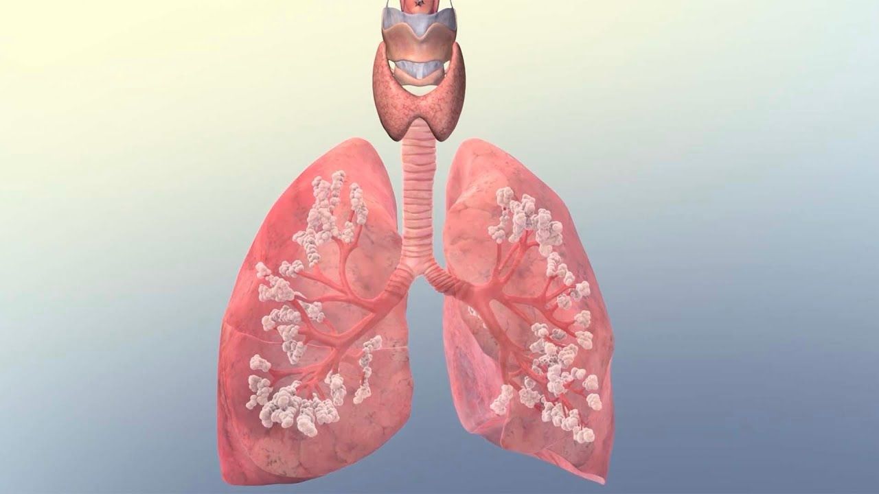 呼吸衰竭的常见原因 | 医学动画 | 健康教育