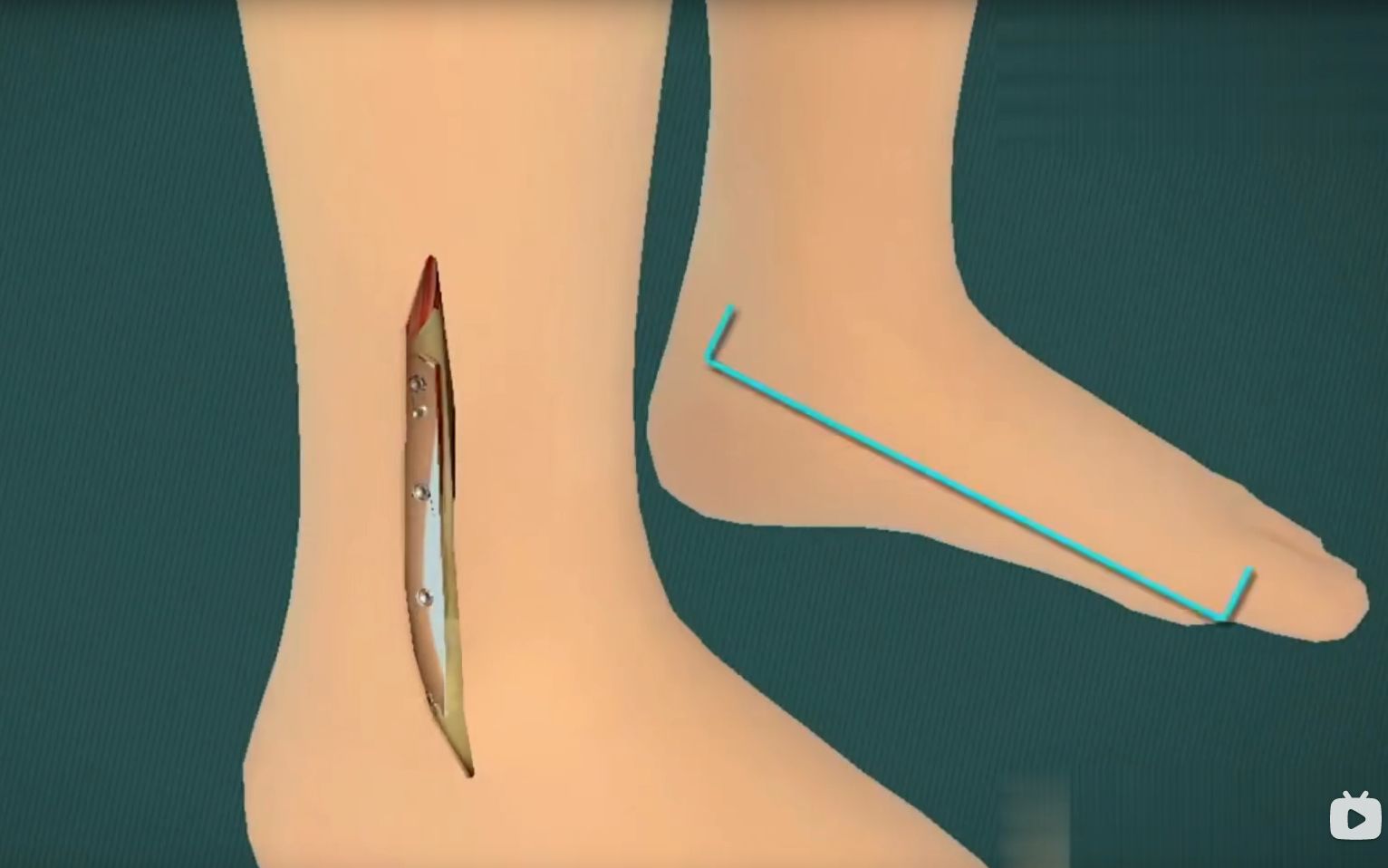 3D医学视频:脚踝骨折修复手术