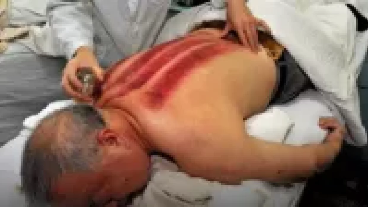 刮痧刮出的黑色,真的是身体里的毒素吗?听老中医怎么说